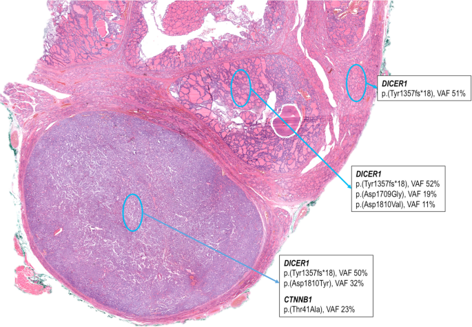 DICER1-Related Pediatric Thyroid Neoplasm with Follicular and Morular ...