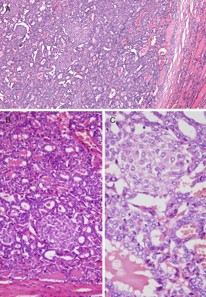 DICER1-Related Pediatric Thyroid Neoplasm with Follicular and Morular ...