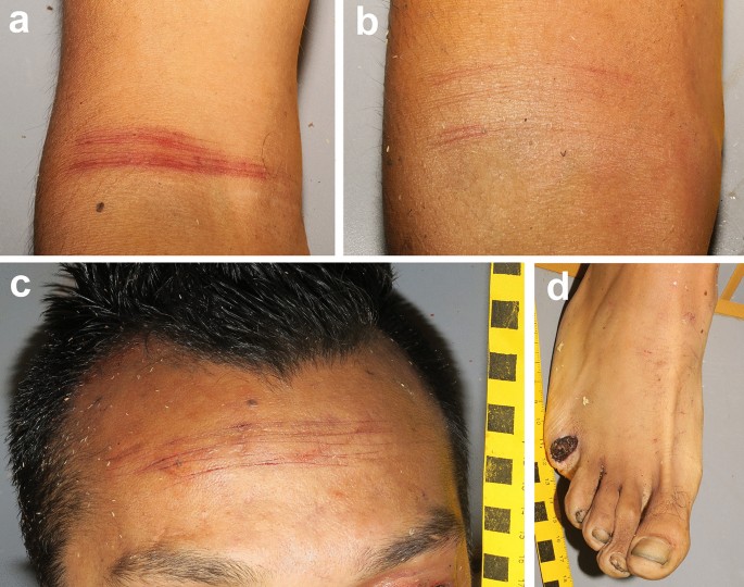 Suicide by sharp force associated with major self-mutilation and self ...