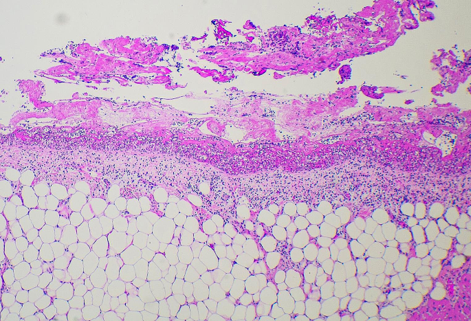 Cardiac tamponade – a rare cause of sudden death in autoimmune ...