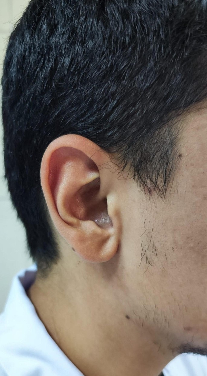 Prevalence of Frank’s sign in healthy young individuals, morphological ...