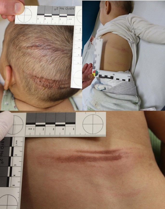 Accident or abuse? Differential diagnosis of contact burns from ...