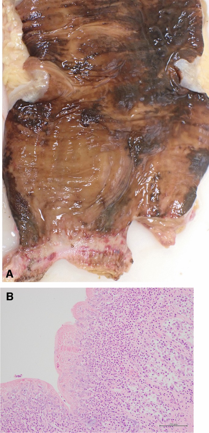 Forensic considerations in cases of fatal constipation | Forensic ...
