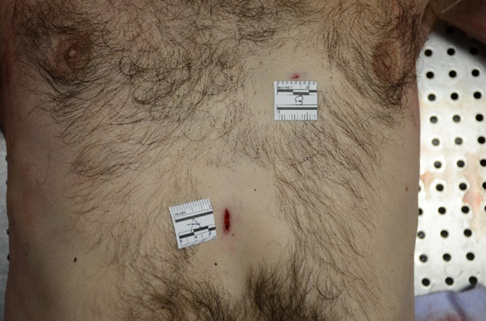 A rare complication of a thoracic wound: the pneumopericardium ...