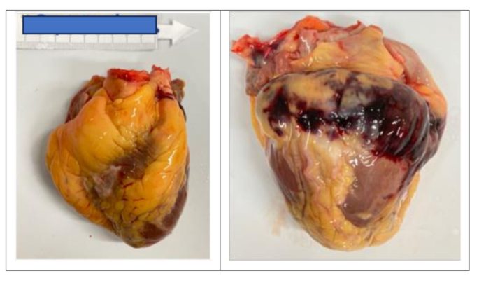 Diagnosing coronary artery dissection using virtual autopsy in a ...