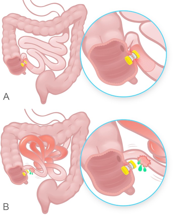 Intestinal volvulus and obstruction due to combined button battery and ...