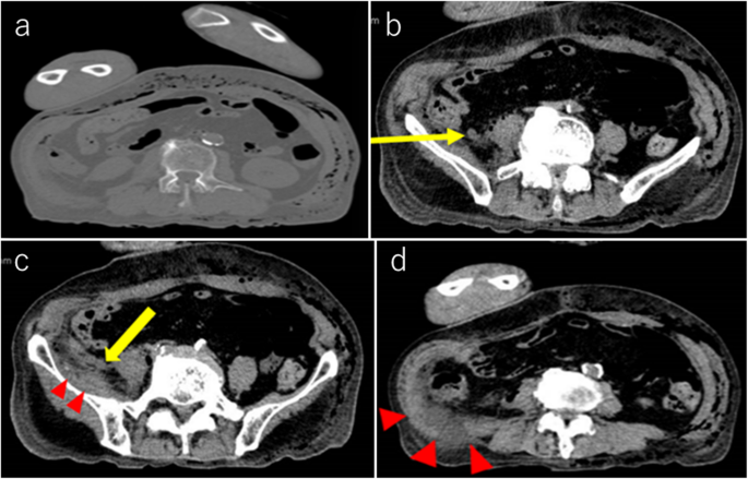 Acute appendicitis in a malpositioned appendix leading to ...