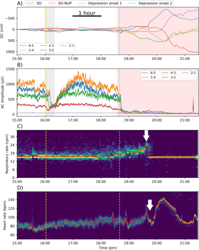 Lessons to Learn from Multimodal Neuromonitoring of Brain Death with ...
