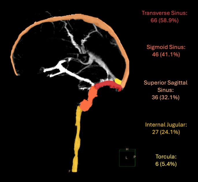 Traumatic Venous Sinus Thrombosis: Patient and Practice Patterns at a ...
