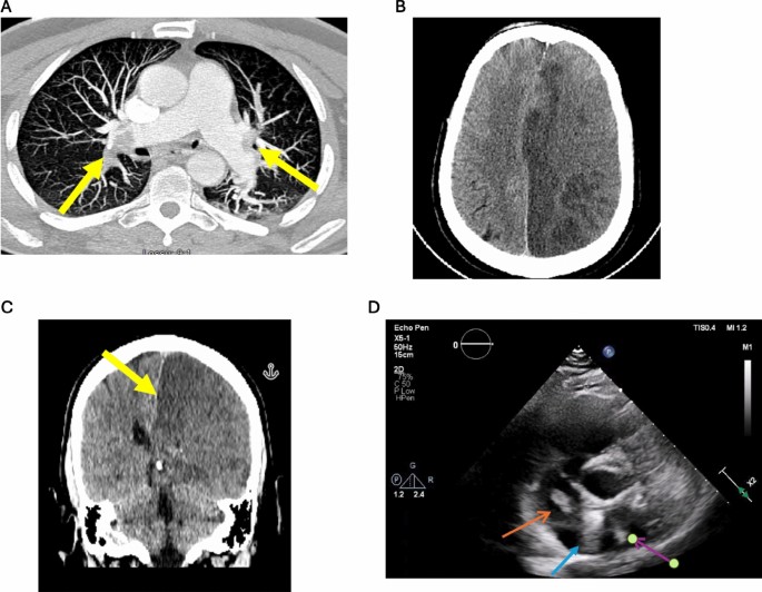 Echoes of Danger: Clot in Transit Causing Stroke and Pulmonary Embolism ...