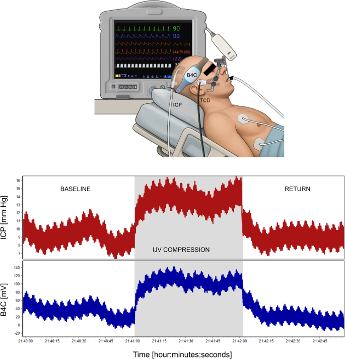 Invasive and Noninvasive Intracranial Pressure Pulse Waveform in ...