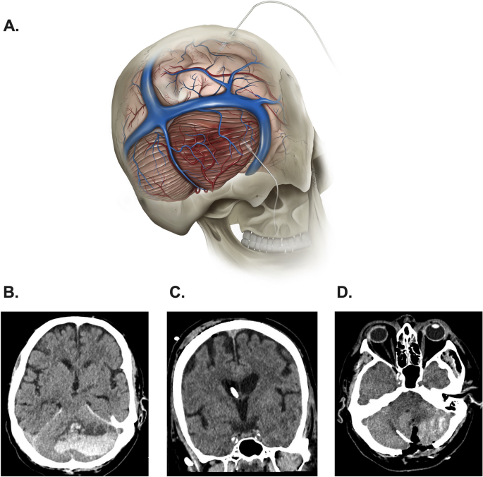 Infratentorial Pressure Monitoring in Cerebellar Stroke: Feasibility ...