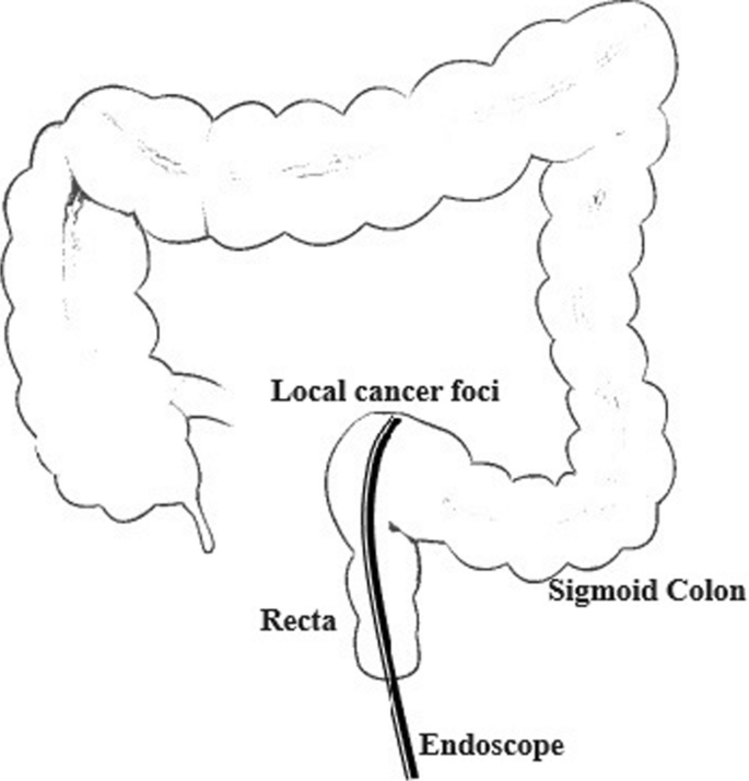 Endoscopic Resection of Stage T1 Colorectal Adenocarcinoma Followed by ...