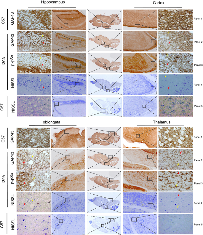 Aberrance of GAP43/p-GAP43 Closely Associates with the Pathology of ...