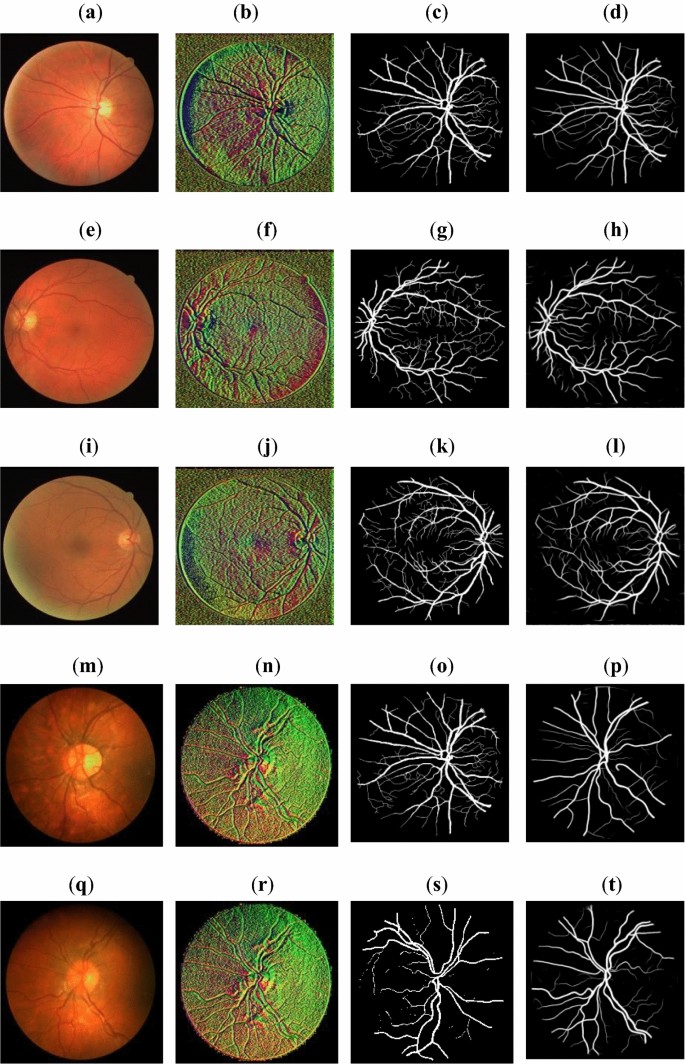 Retinal blood vessel detection using deep learning with texture ...