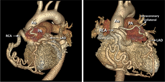 Adult-type ALCAPA: missed at preoperative evaluation | Indian Journal ...