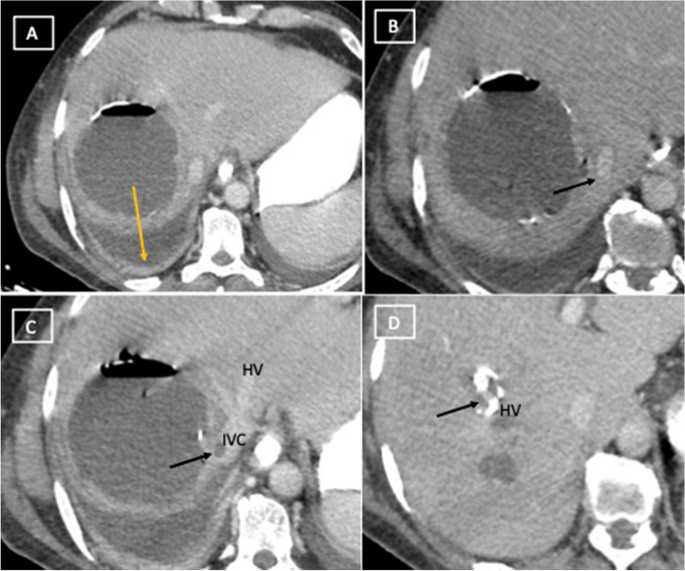 Spontaneous rupture of hepatic hydatid cyst into the inferior vena cava ...