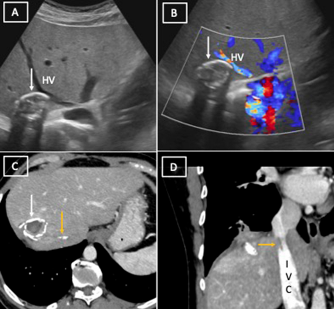 Spontaneous rupture of hepatic hydatid cyst into the inferior vena cava ...