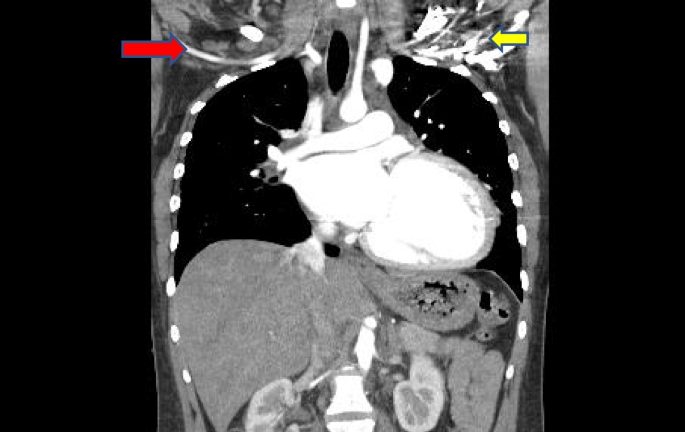 Successful implantation and removal of Impella 5.5 device via a 4-mm ...