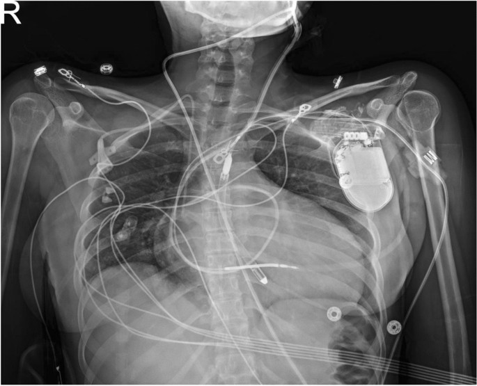 Successful implantation and removal of Impella 5.5 device via a 4-mm ...