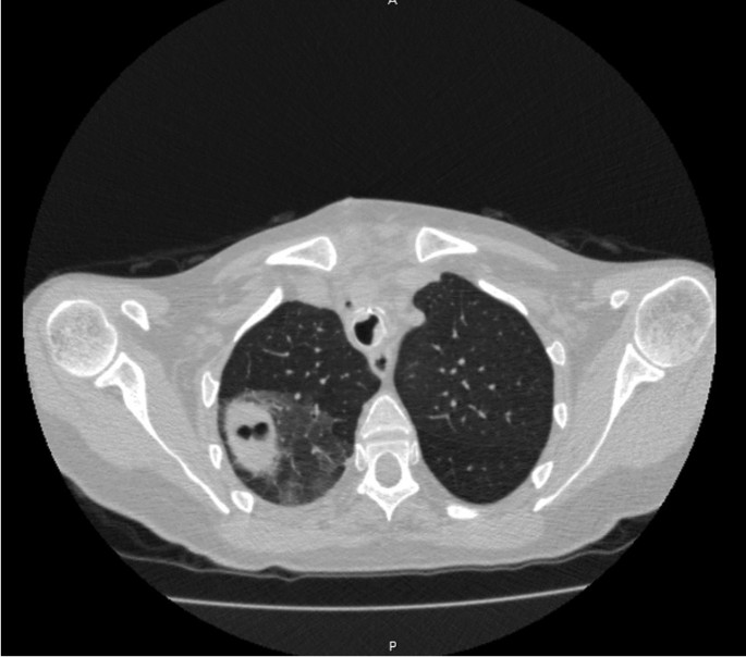 Pericardial patch tracheobronchoplasty for airway stenosis due to ...