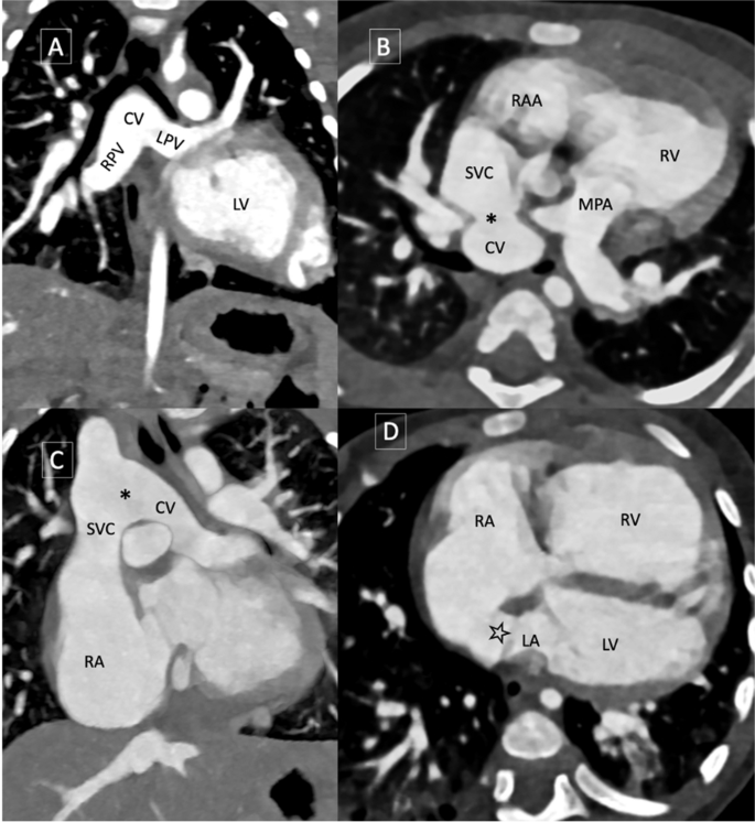 Supracardiac total anomalous pulmonary venous drainage with right-sided ...