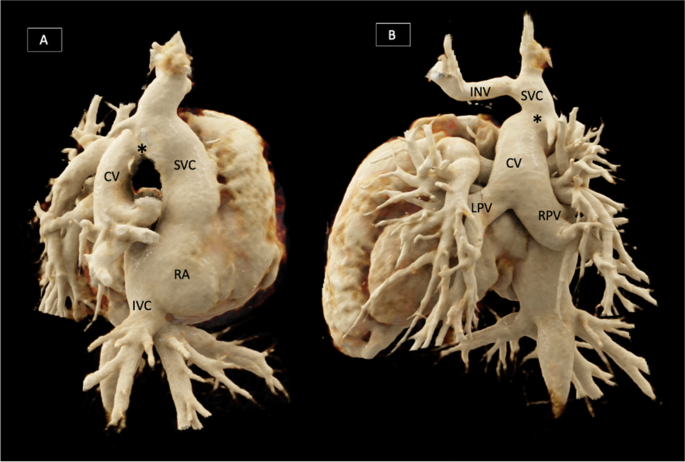 Supracardiac total anomalous pulmonary venous drainage with right-sided ...