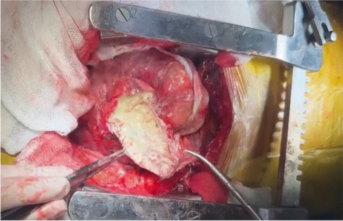 Pericardial sebaceous cyst masquerading as constrictive pericarditis ...