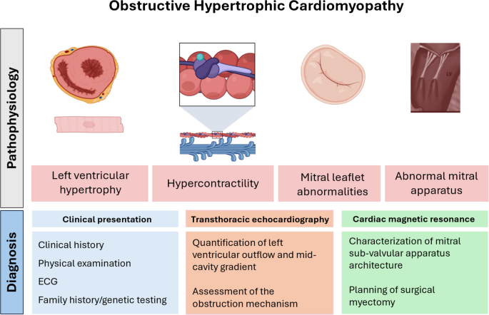 Obstructive hypertrophic cardiomyopathy: pathophysiology and diagnosis ...