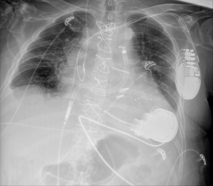 Use of LVAD HeartMate 3 and Impella RP in the management of advanced ...