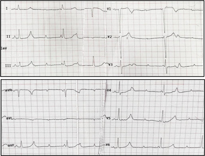 Reversal of hypercalcemia-induced complete heart block (CHB) with ...
