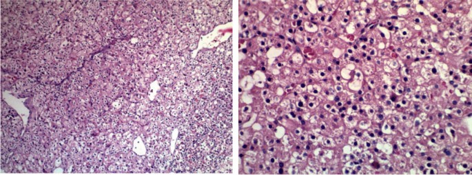 Reversal of hypercalcemia-induced complete heart block (CHB) with ...
