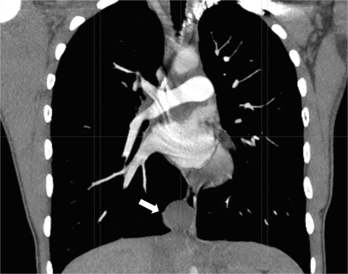 Uniportal video-assisted thoracoscopic surgery as a treatment option ...