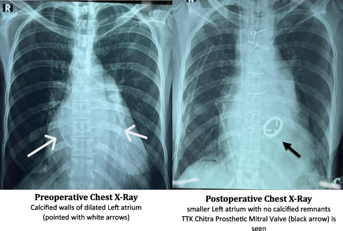 Porcelain left atrium, from stone to function — a surgical challenge ...