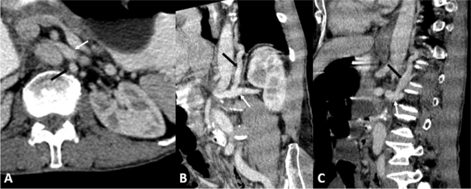 Reno-hemiazygos venous connection identified on contrast-enhanced ...