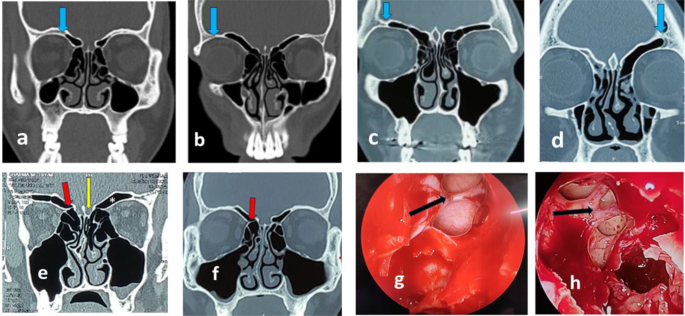 Supraorbital Ethmoid Air Cell – Its Role in Sinonasal Pathologies ...