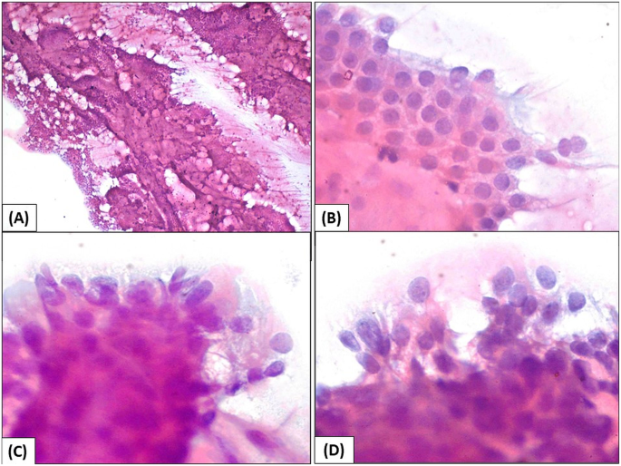 Cytologic and Clinicopathologic Features of Papillary Thyroid Carcinoma ...