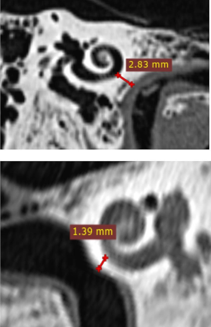 Cochlear-Carotid Interval: Bridging Surgical Insights and Radiological ...