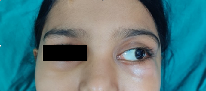 Ewing’s Sarcoma of Maxillary Sinus | Indian Journal of Otolaryngology ...