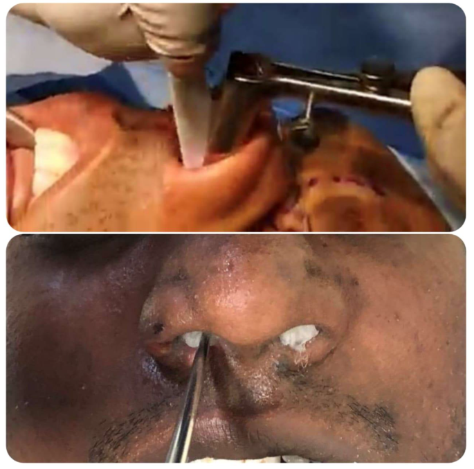 Comparative Study on Finger Gloves Nasal Packing Vs Merocel Nasal ...