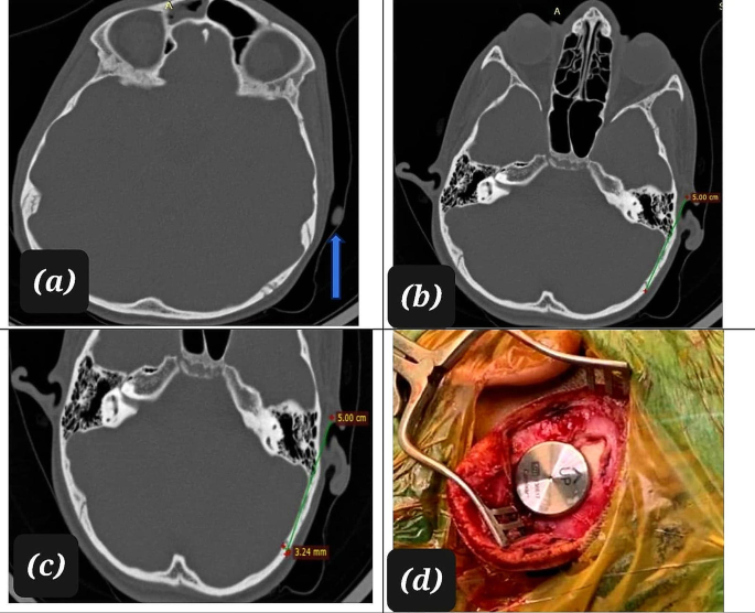Outcome Evaluation of BAHA Attract System Implantations | Indian ...