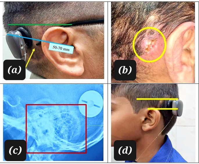 Outcome Evaluation of BAHA Attract System Implantations | Indian ...