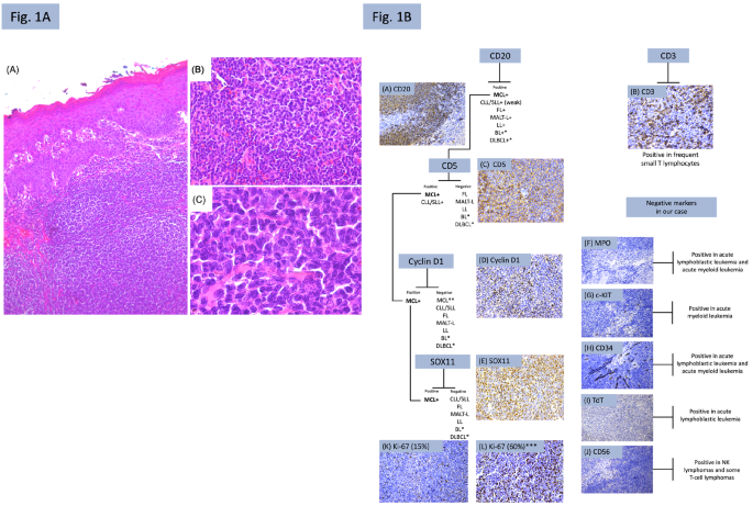 Mantle Cell Lymphoma in the Oral Cavity: Exploring the Differential ...