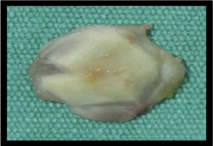 Study of Anatomical Results and Hearing Improvement in Various Types of ...