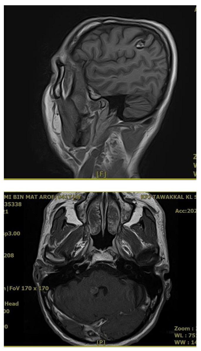 Multiple Cerebral Cavernous Malformation: An Unusual Cause of Vertigo ...