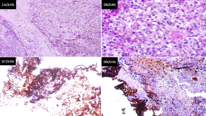 Malignant Melanoma of the Oral Cavity: An Aggressive and Rare Entity ...