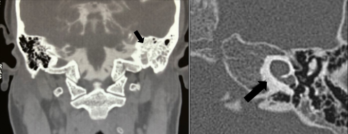 Diagnosis and Management of Paradoxical Cerebrospinal Rhinnorhea in ...