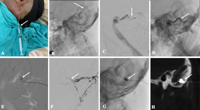 Pulsatile Tinnitus Due to a Large Mastoid Emissary Vein: Successfully ...