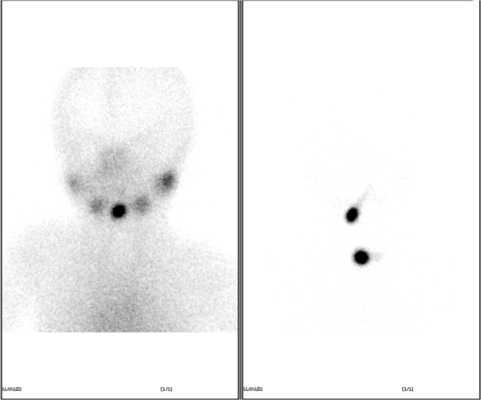 Sublingual Ectopic Thyroid Presenting with Congenital Hypothyroidism ...