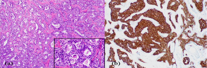 Ceruminous Adenoma: A Case Report and Review of Literature | Indian ...